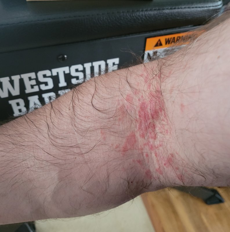 Anyone seen rashes like this? Welts? Eczema? | Body Building Forum ...